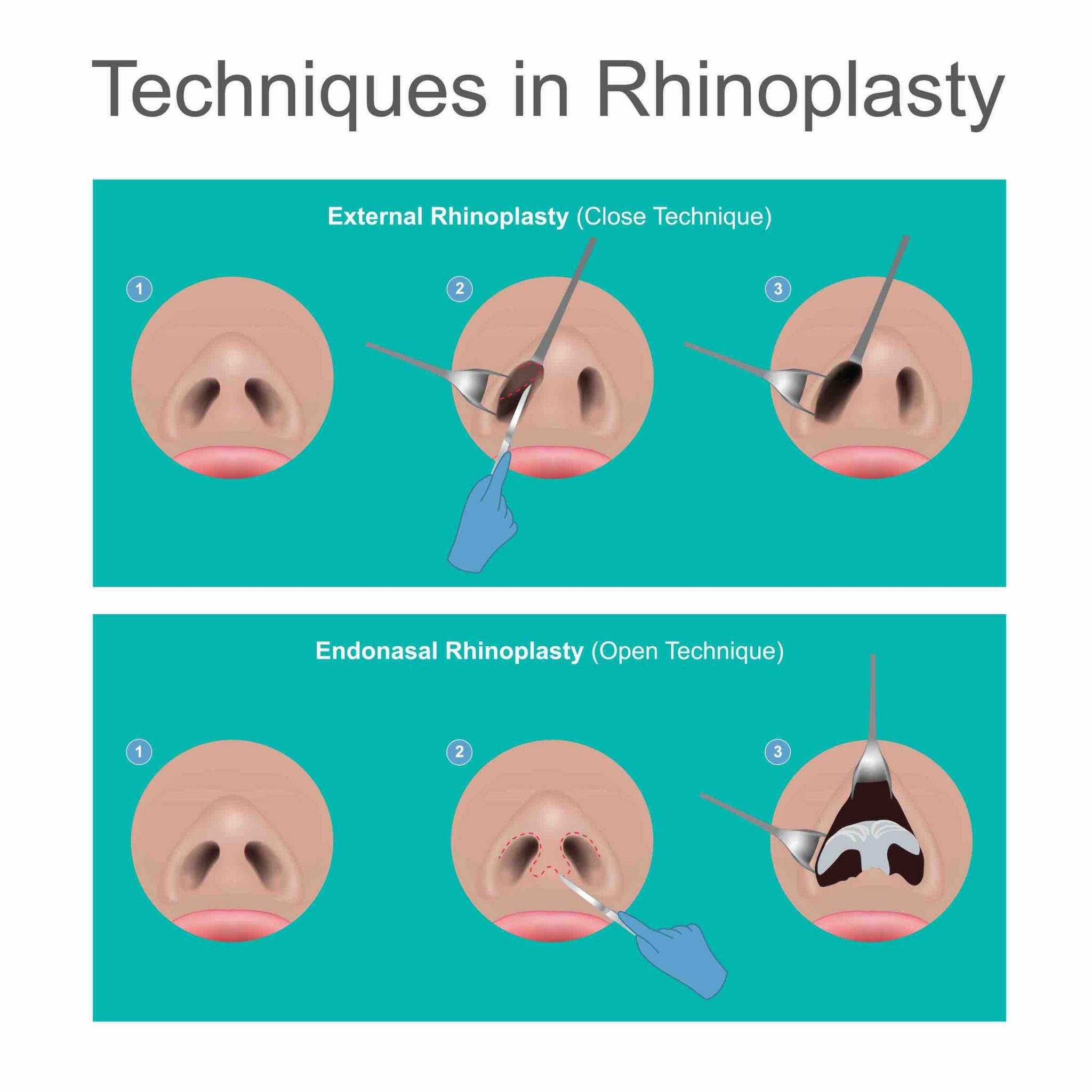 Nose Tip Surgery | Tip Rhinoplasty Gold Coast