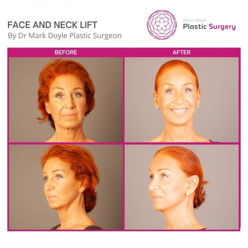 5 Telltale Signs of Good Facelift Results | Dr Doyle