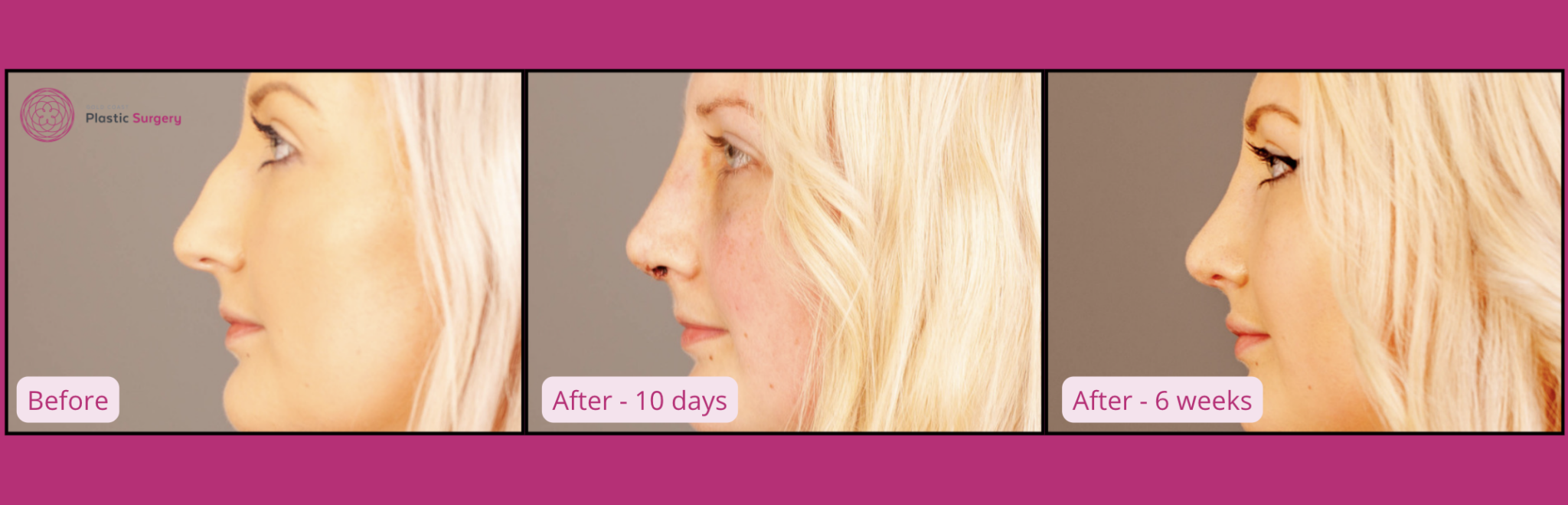 Rhinoplasty Recovery | goldcoastplasticsurgery.com.au